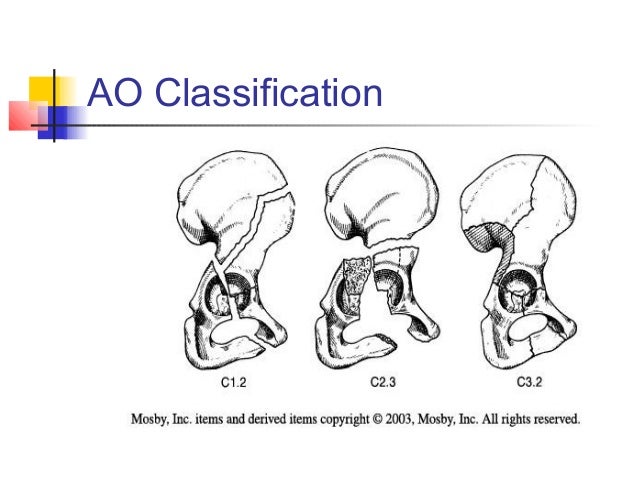 Acetabular fraacture management with surgical approaches