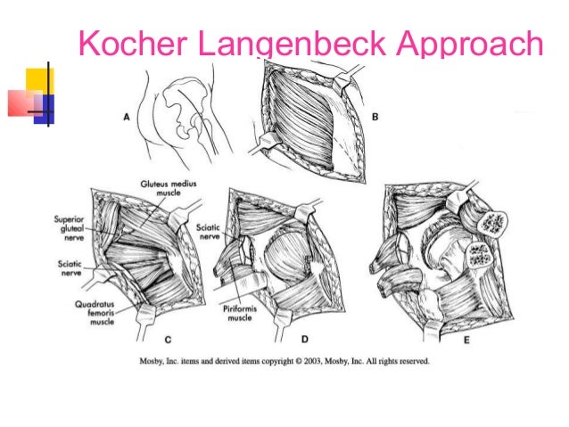 Acetabular fraacture management with surgical approaches