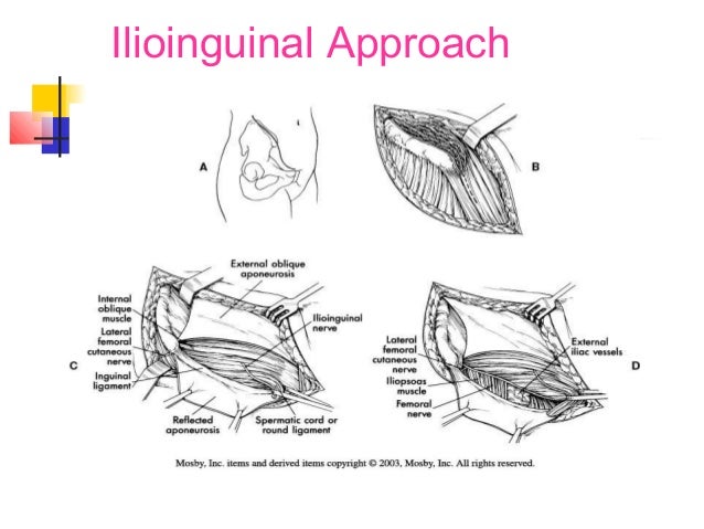 Acetabular fraacture management with surgical approaches