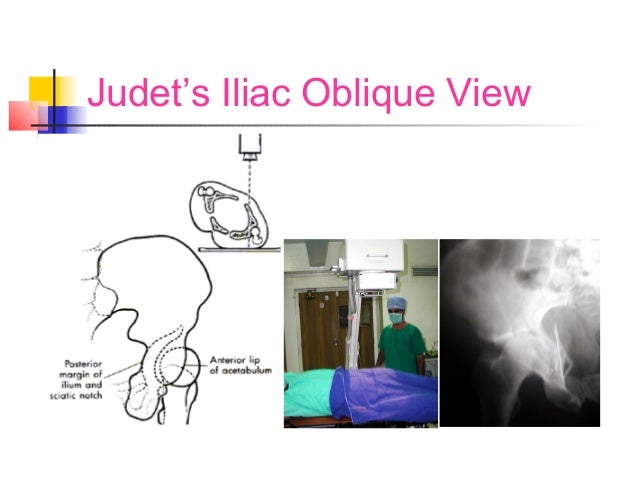 Acetabular fraacture management with surgical approaches