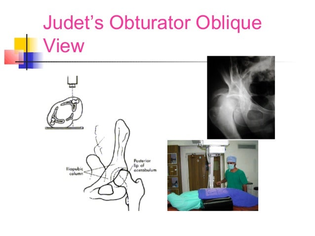 Acetabular fraacture management with surgical approaches