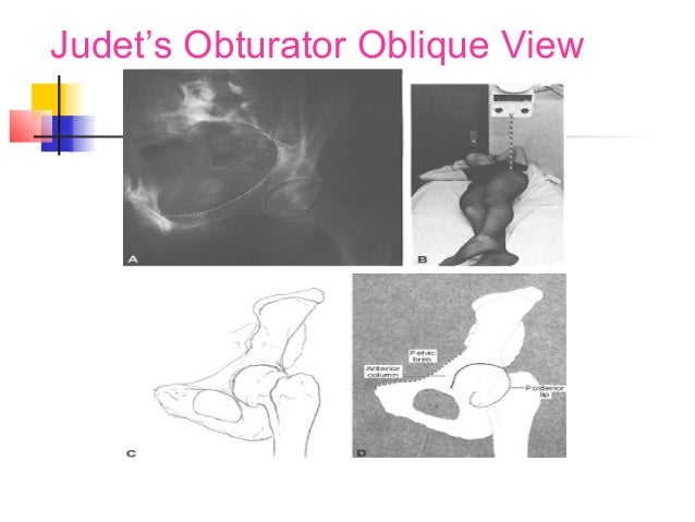 Acetabular fraacture management with surgical approaches