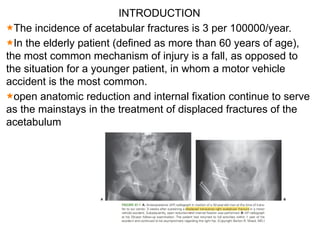 Acetabular fracture etiology and its managements | PPTX