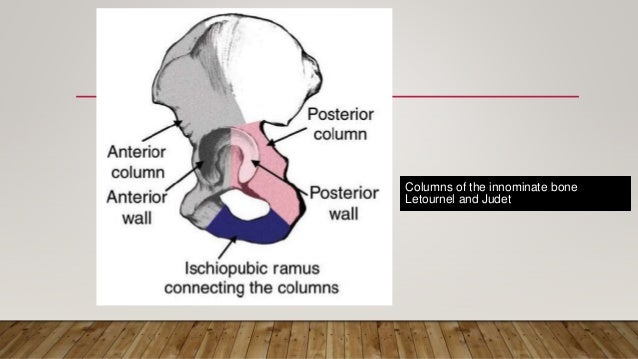 Acetabular fractures