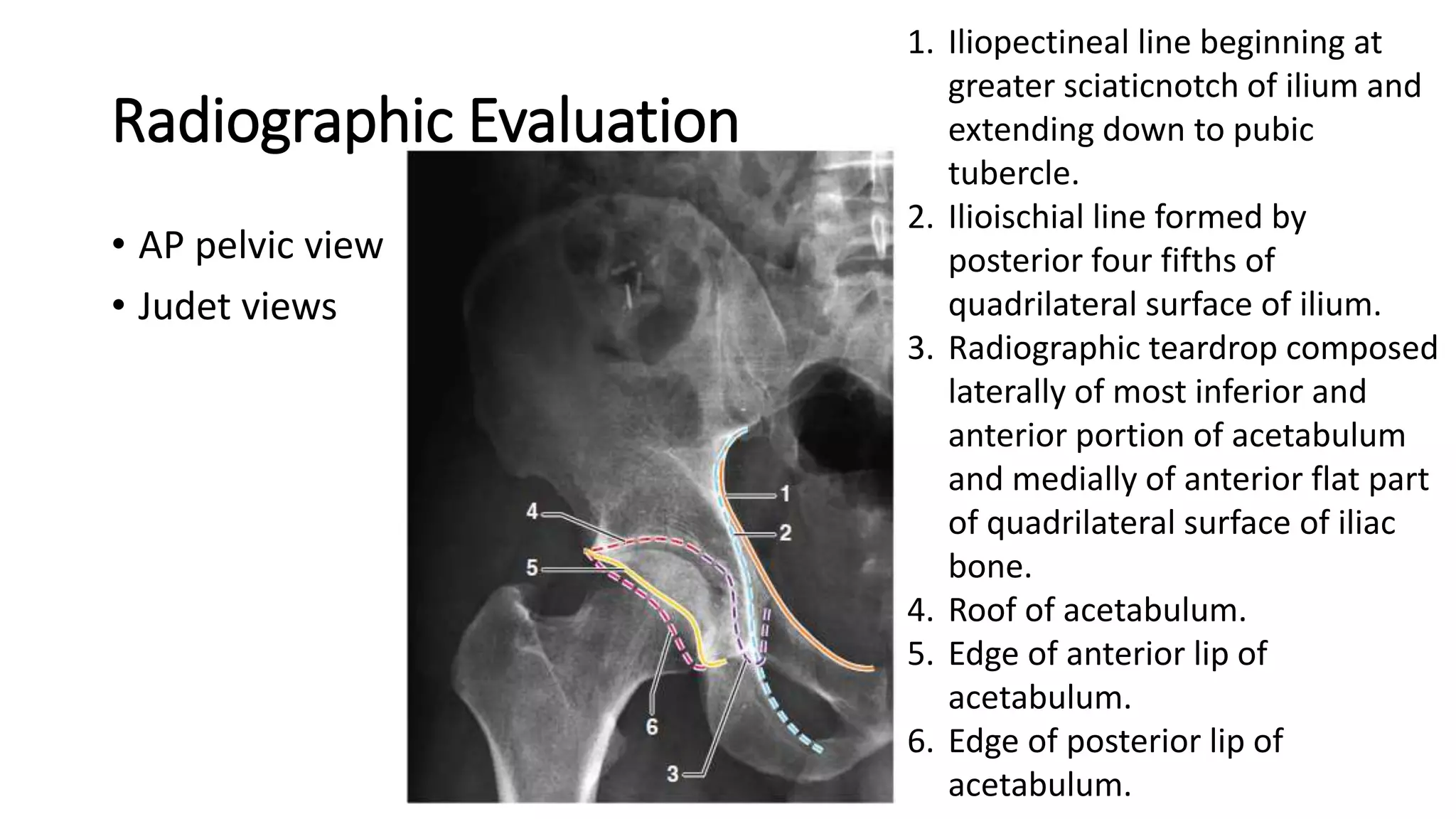 Acetabular Fracture.pptx