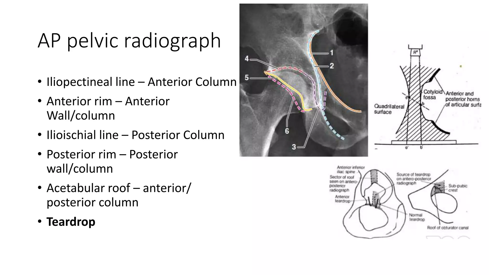 Acetabular Fracture.pptx