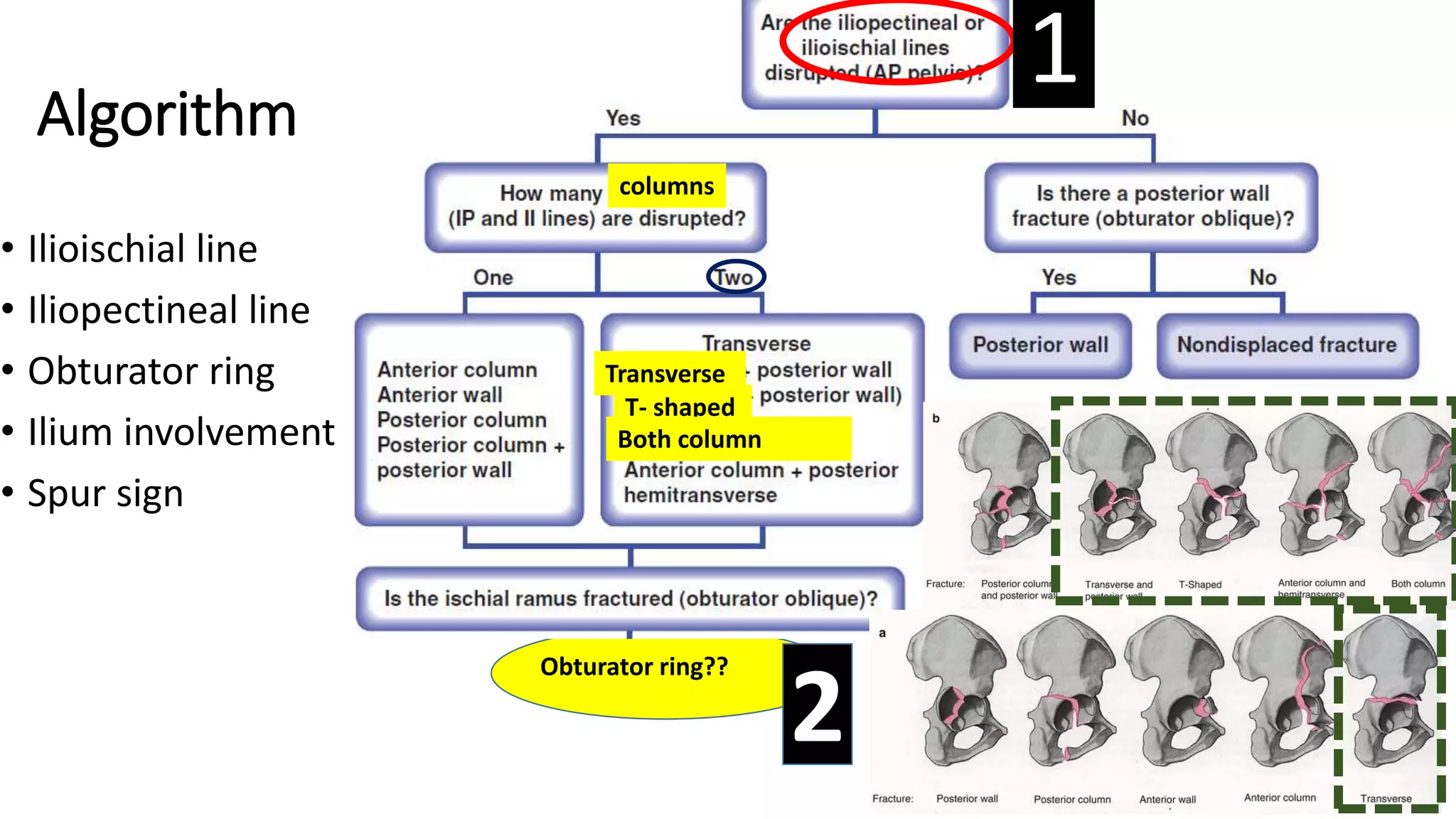 Acetabular Fracture.pptx