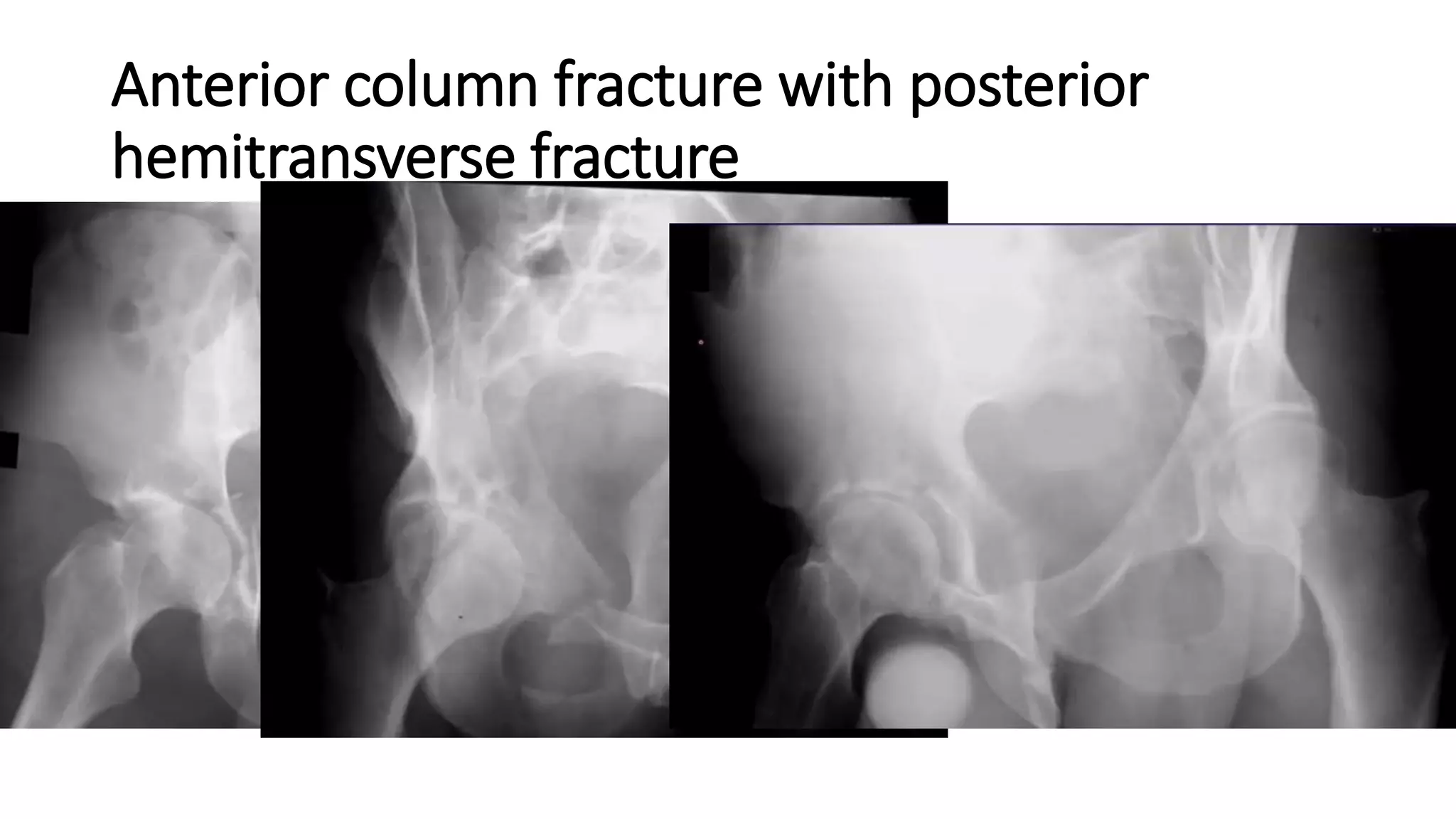 Acetabular Fracture.pptx
