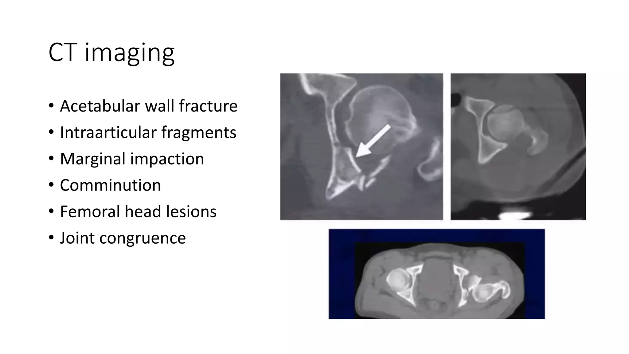 Acetabular Fracture.pptx
