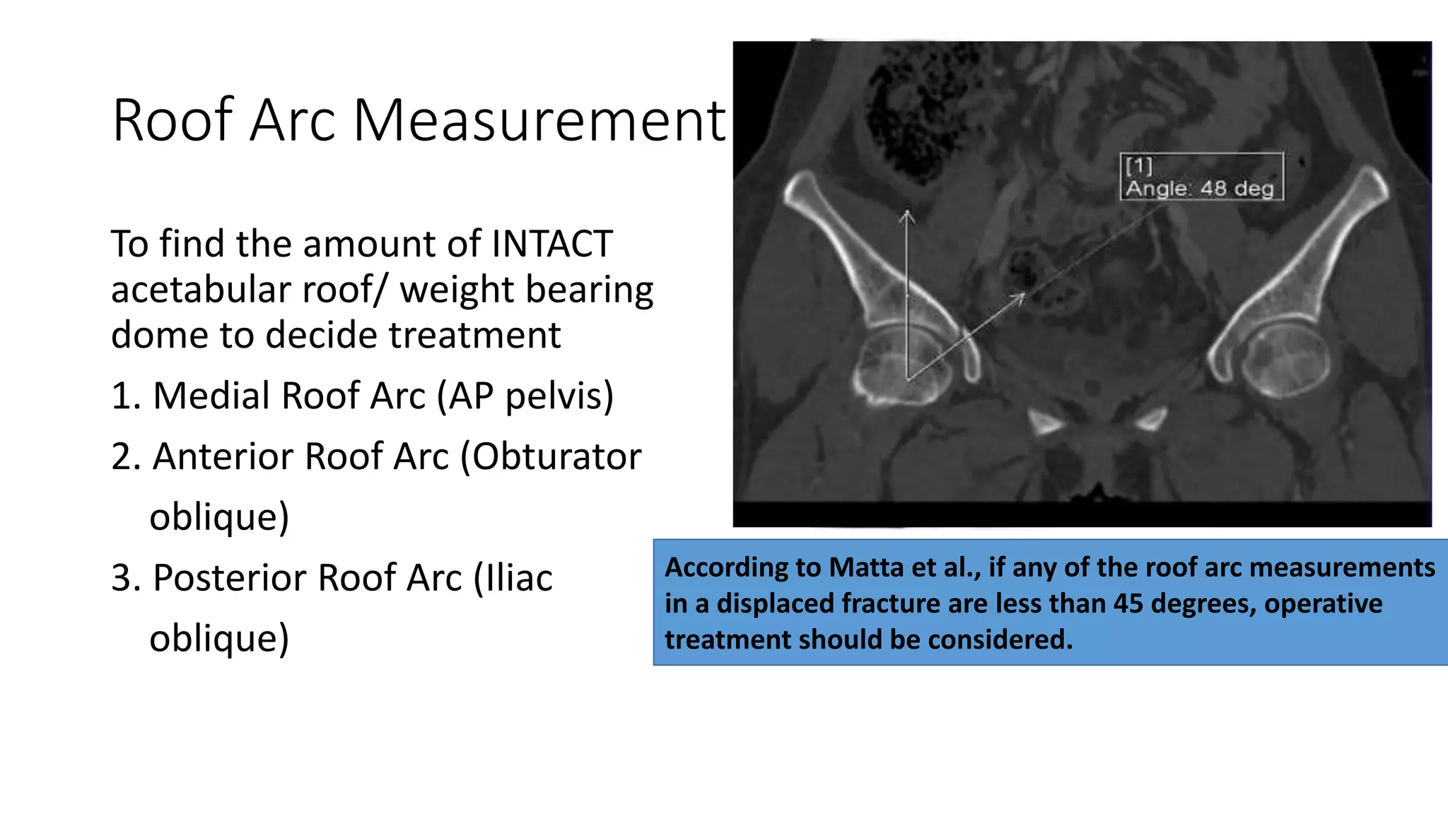 Acetabular Fracture.pptx