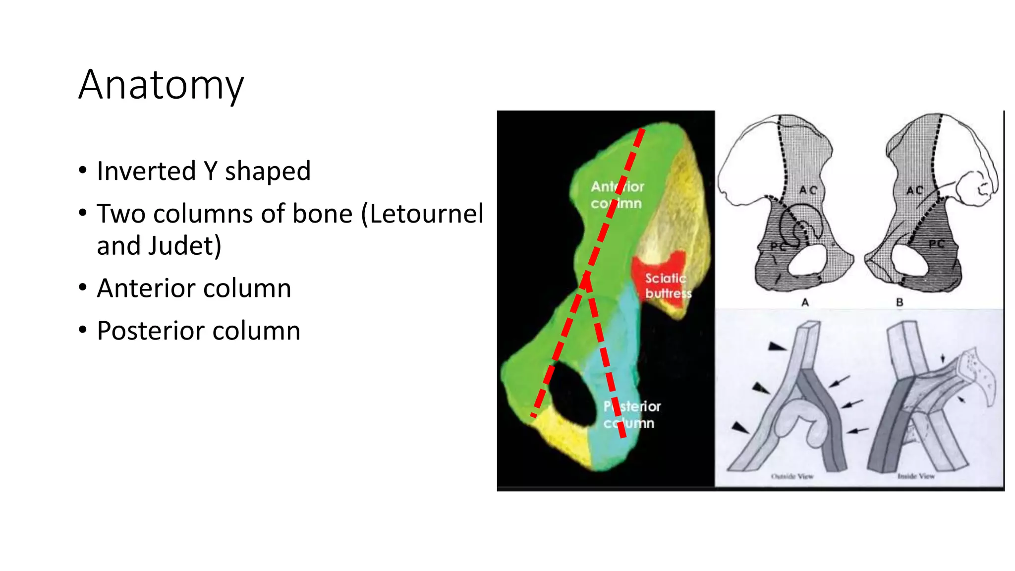 Acetabular Fracture.pptx