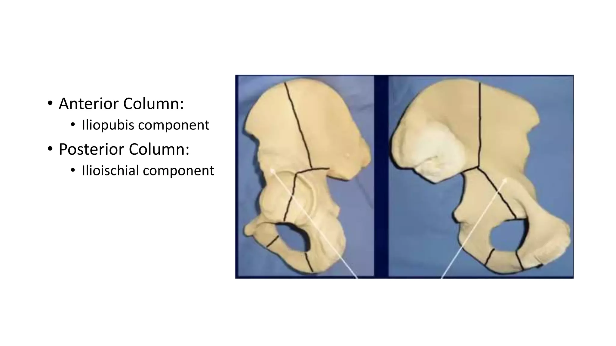 Acetabular Fracture.pptx