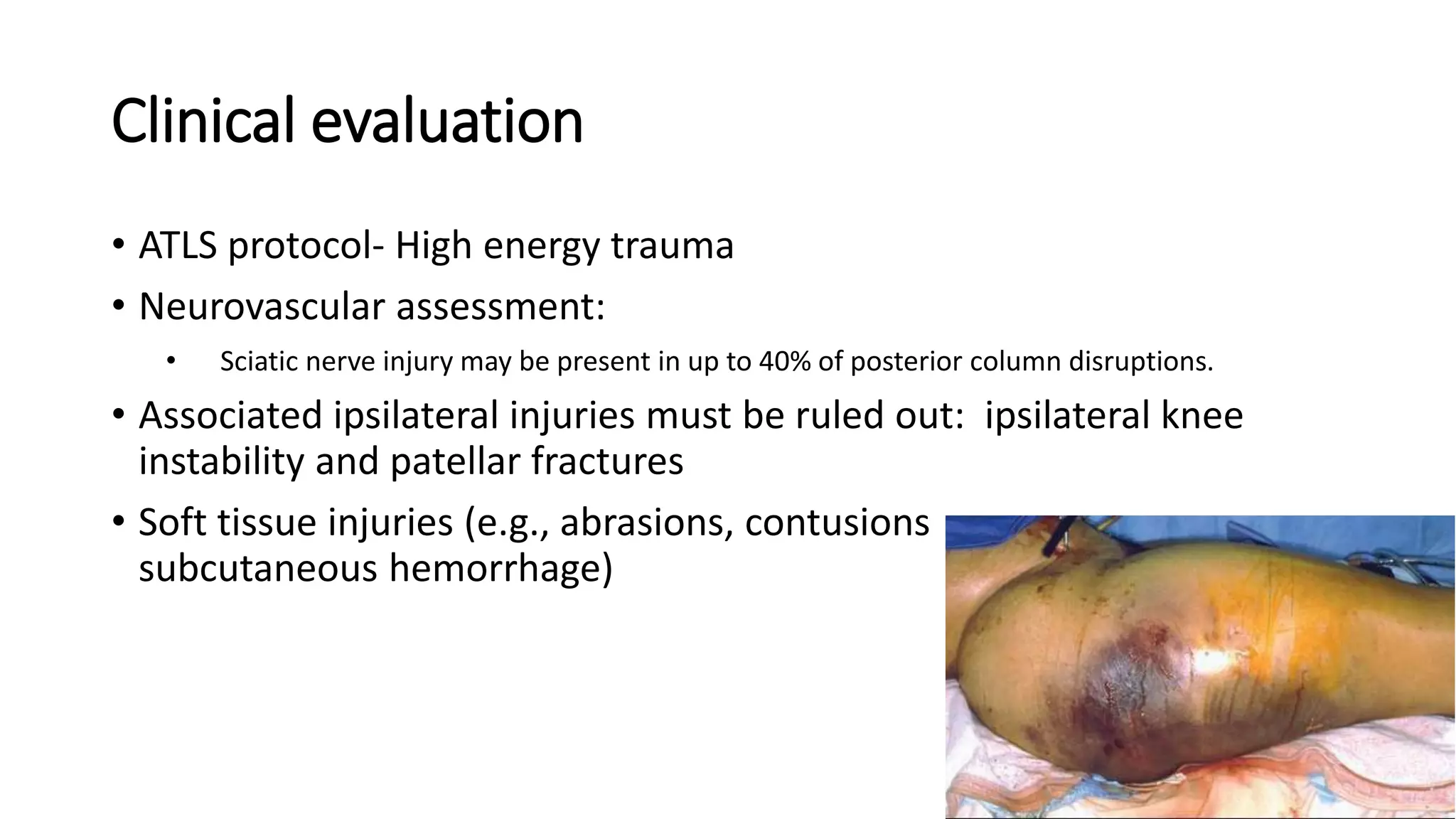 Acetabular Fracture.pptx