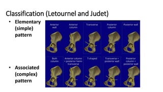 Acetabular Fracture.pptx