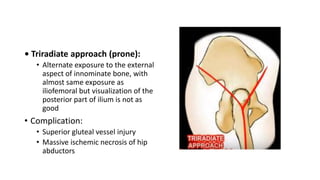 Acetabular Fracture.pptx