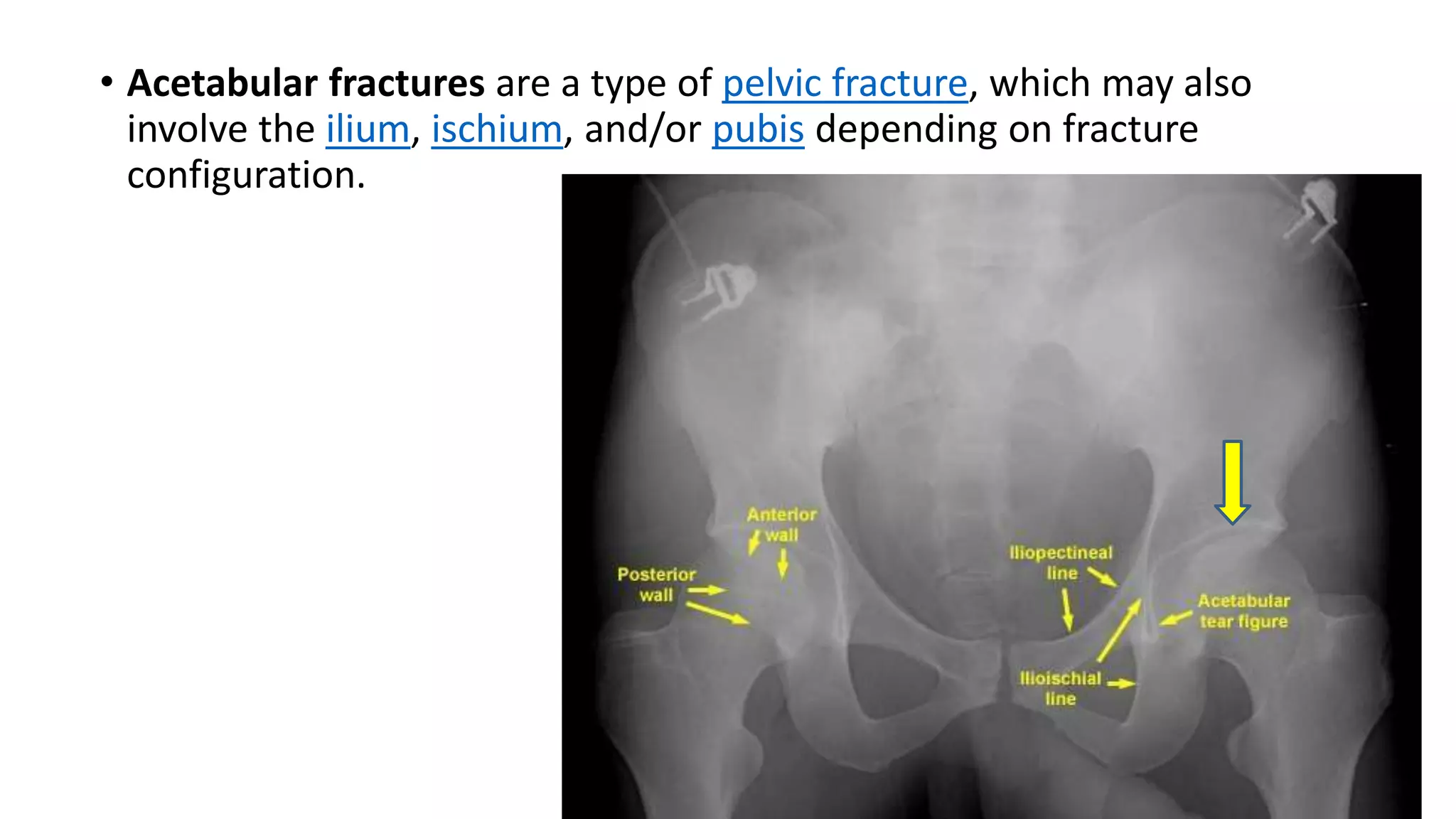 Acetabular fracture new | PPTX