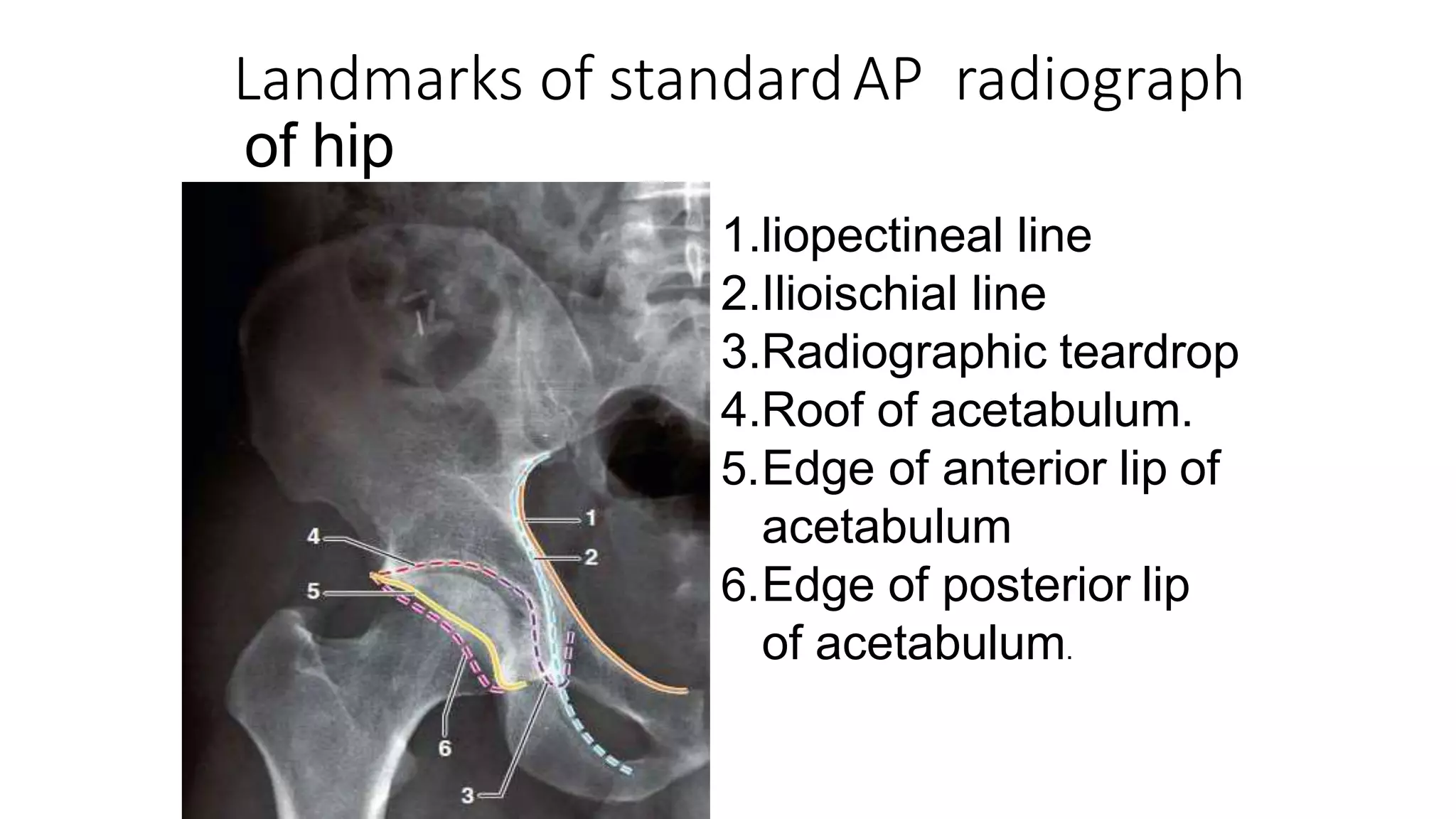 Acetabular fracture new | PPTX
