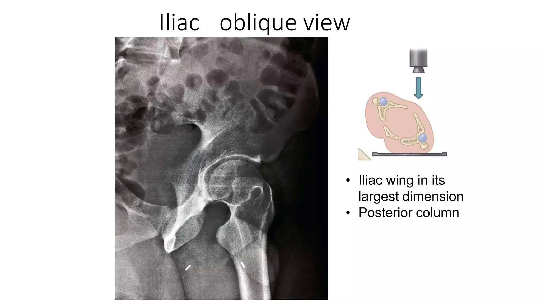 Acetabular fracture new | PPTX