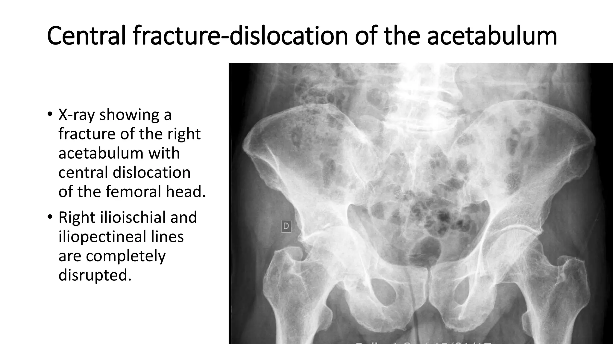 Acetabular fracture new | PPTX