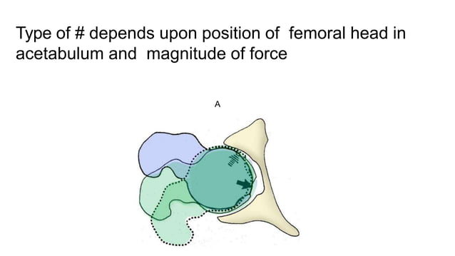 Acetabular fracture new | PPT