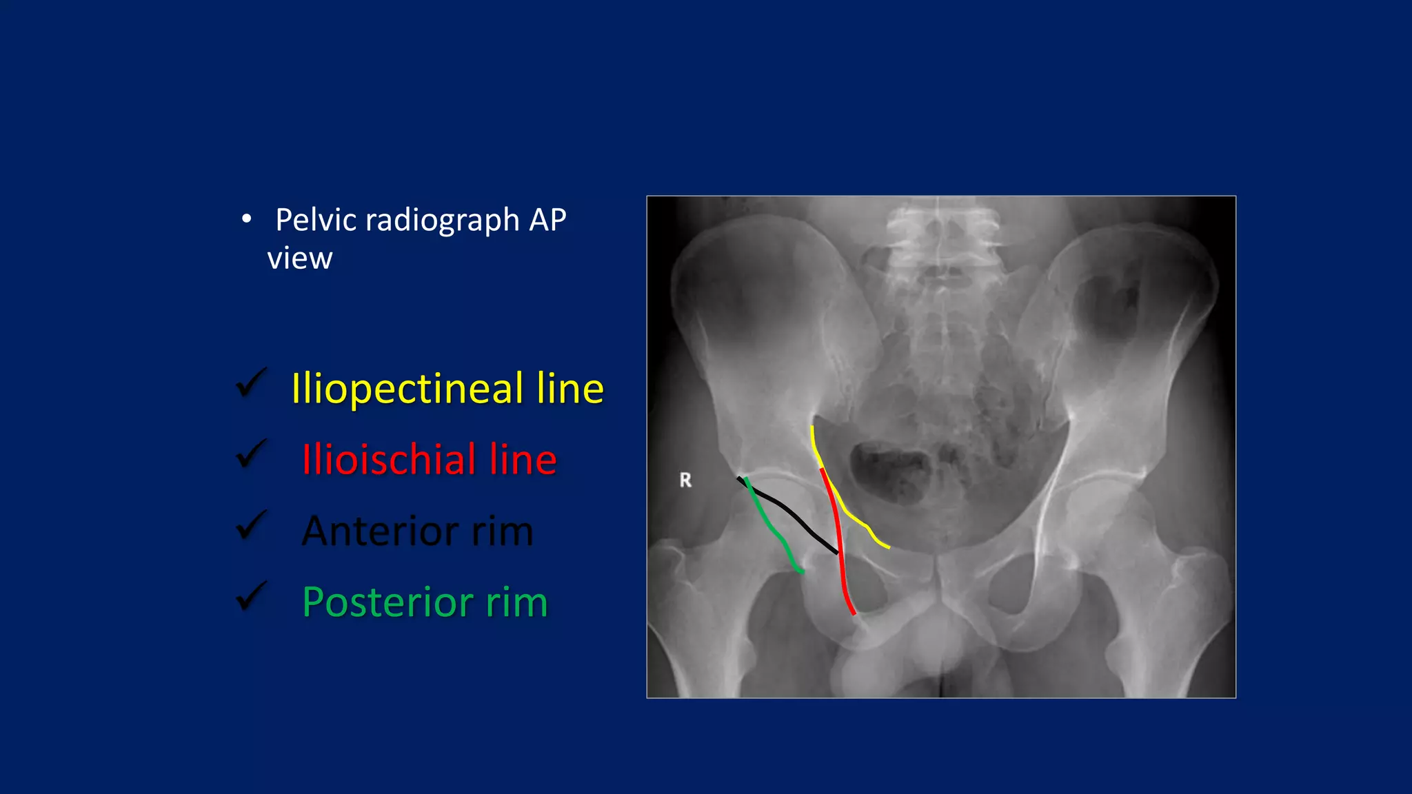 Acetabular fracture ppt 4th sem | PPTX