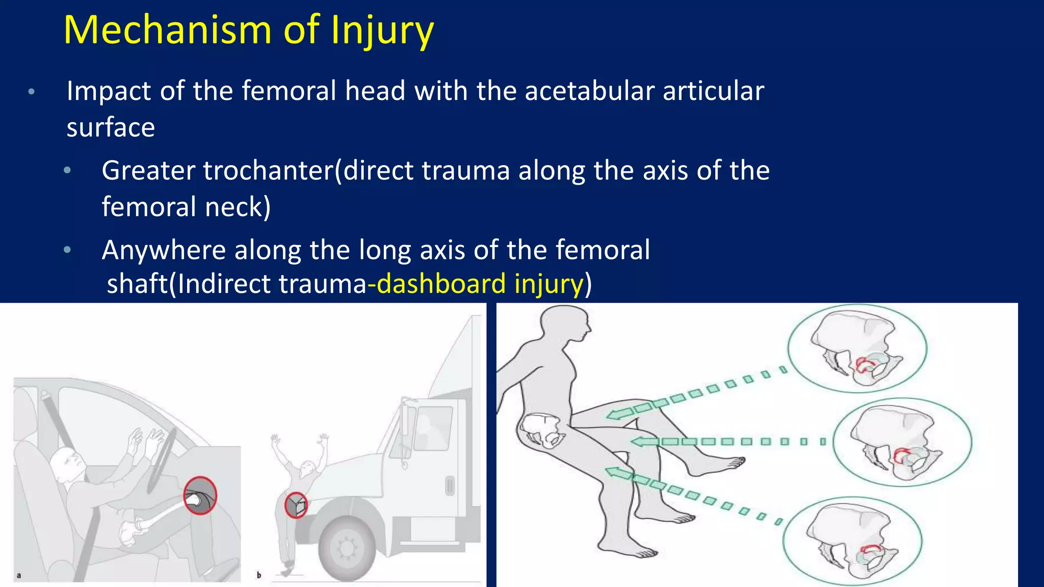 Acetabular fracture ppt 4th sem | PPTX