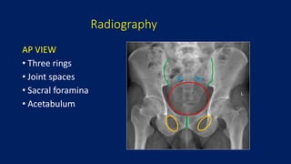 Acetabular fracture ppt 4th sem | PPTX