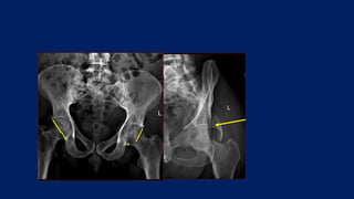 Acetabular fracture ppt 4th sem | PPTX