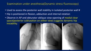 Acetabular fracture ppt 4th sem | PPTX