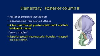 Acetabular fracture ppt 4th sem | PPTX