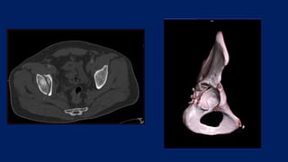Acetabular fracture ppt 4th sem | PPTX