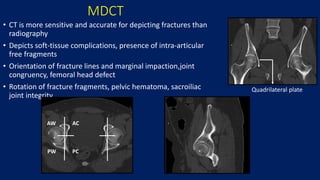 Acetabular fracture ppt 4th sem | PPTX