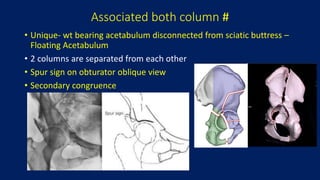 Acetabular fracture ppt 4th sem | PPTX