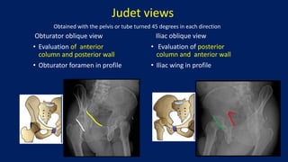Acetabular fracture ppt 4th sem | PPT