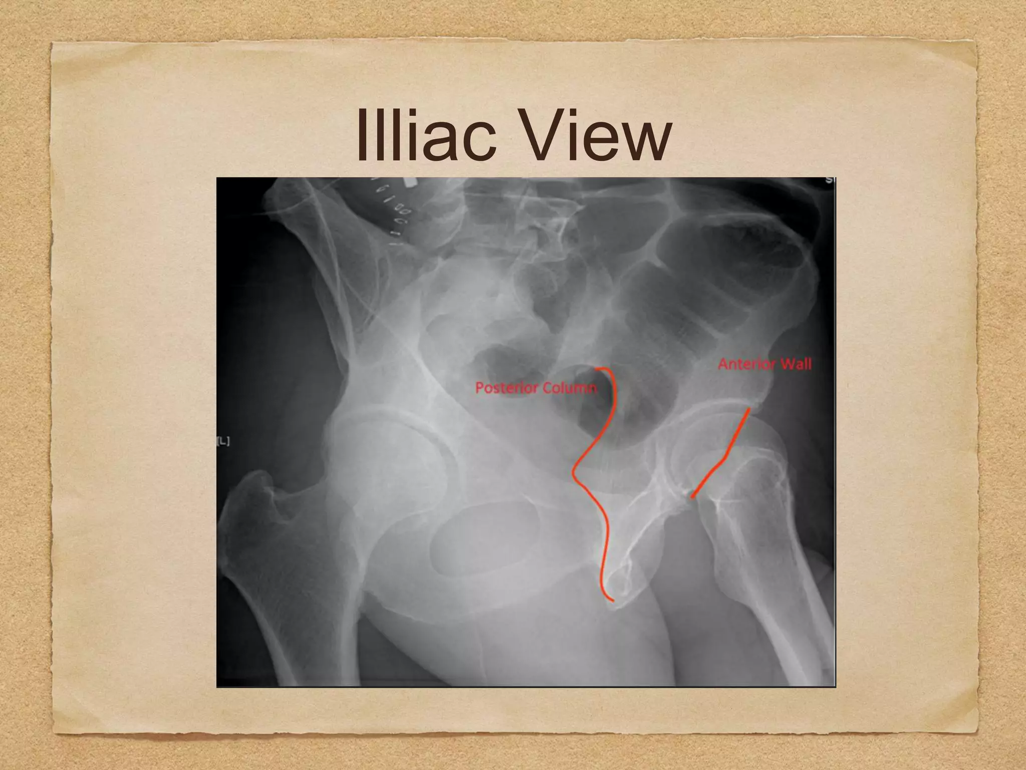 Acetabular Fracture Radiology: Xrays, CT scan & 3D printing | PPTX