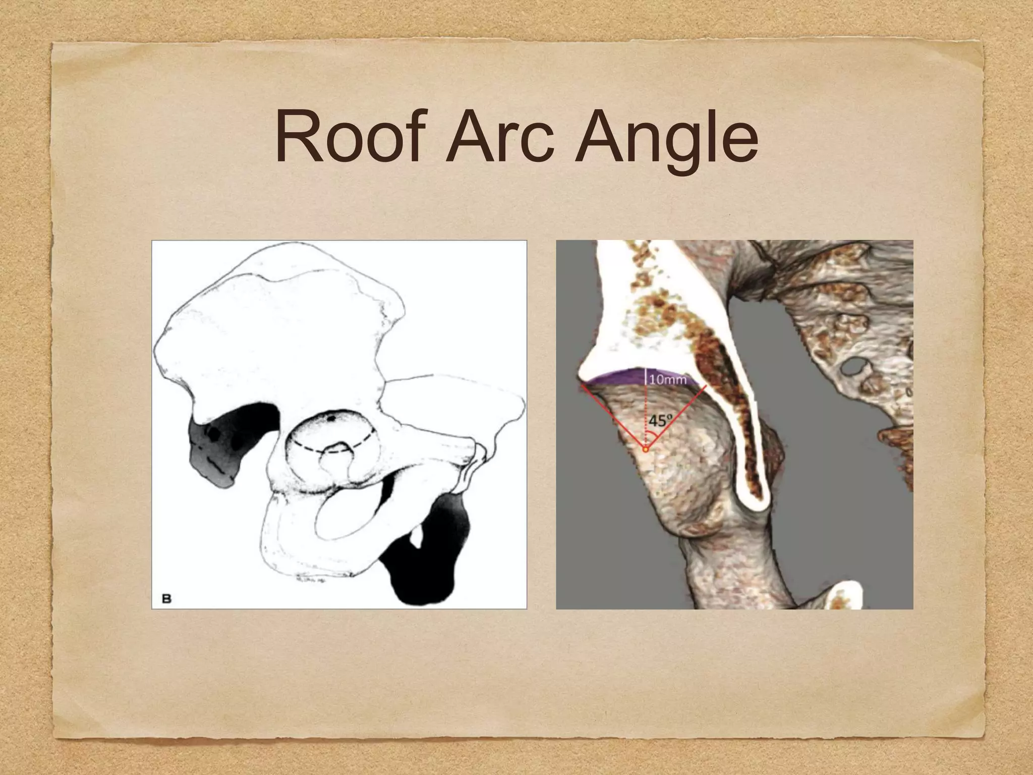 Acetabular Fracture Radiology: Xrays, CT scan & 3D printing | PPTX