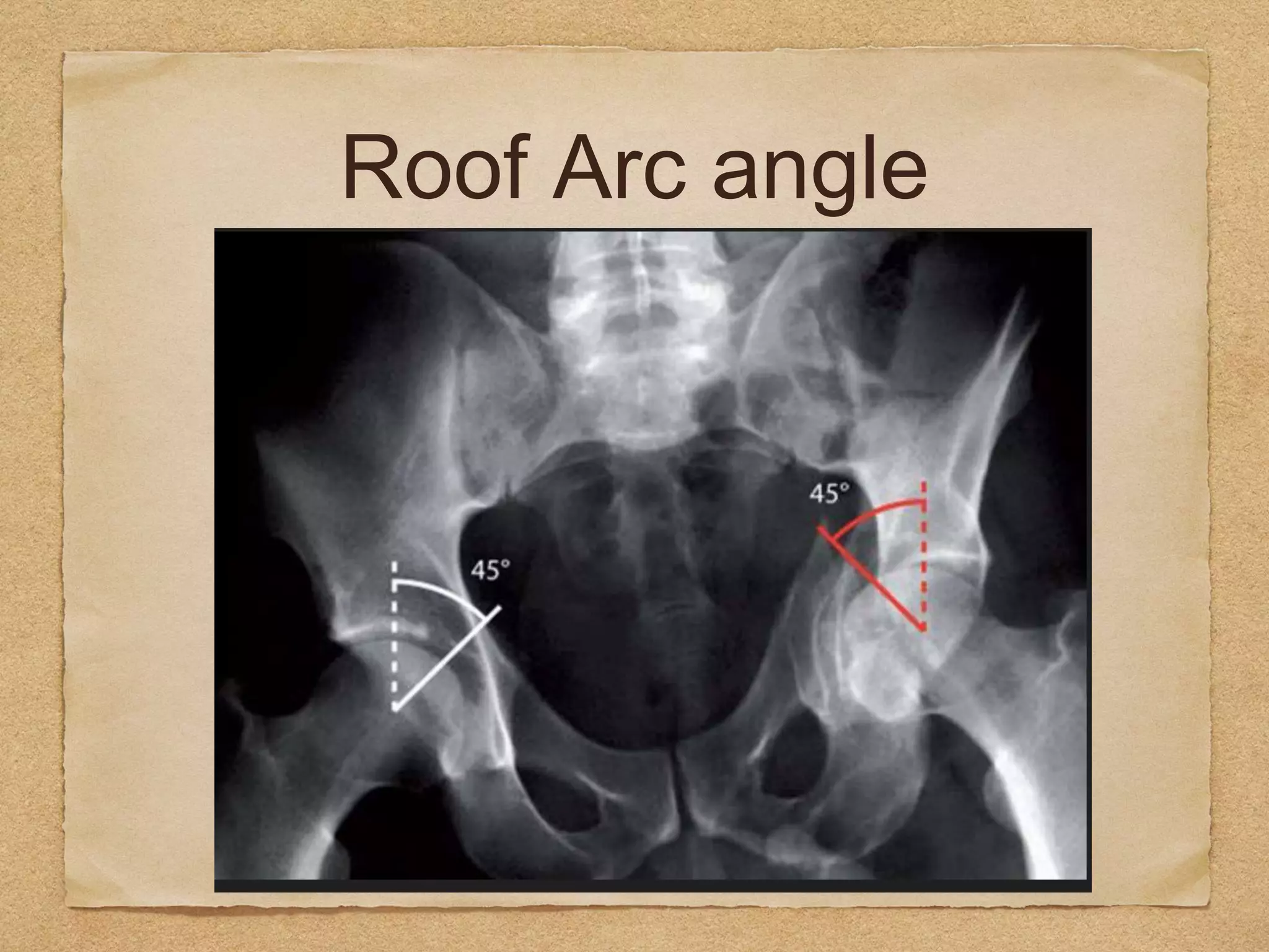 Acetabular Fracture Radiology: Xrays, CT scan & 3D printing | PPTX