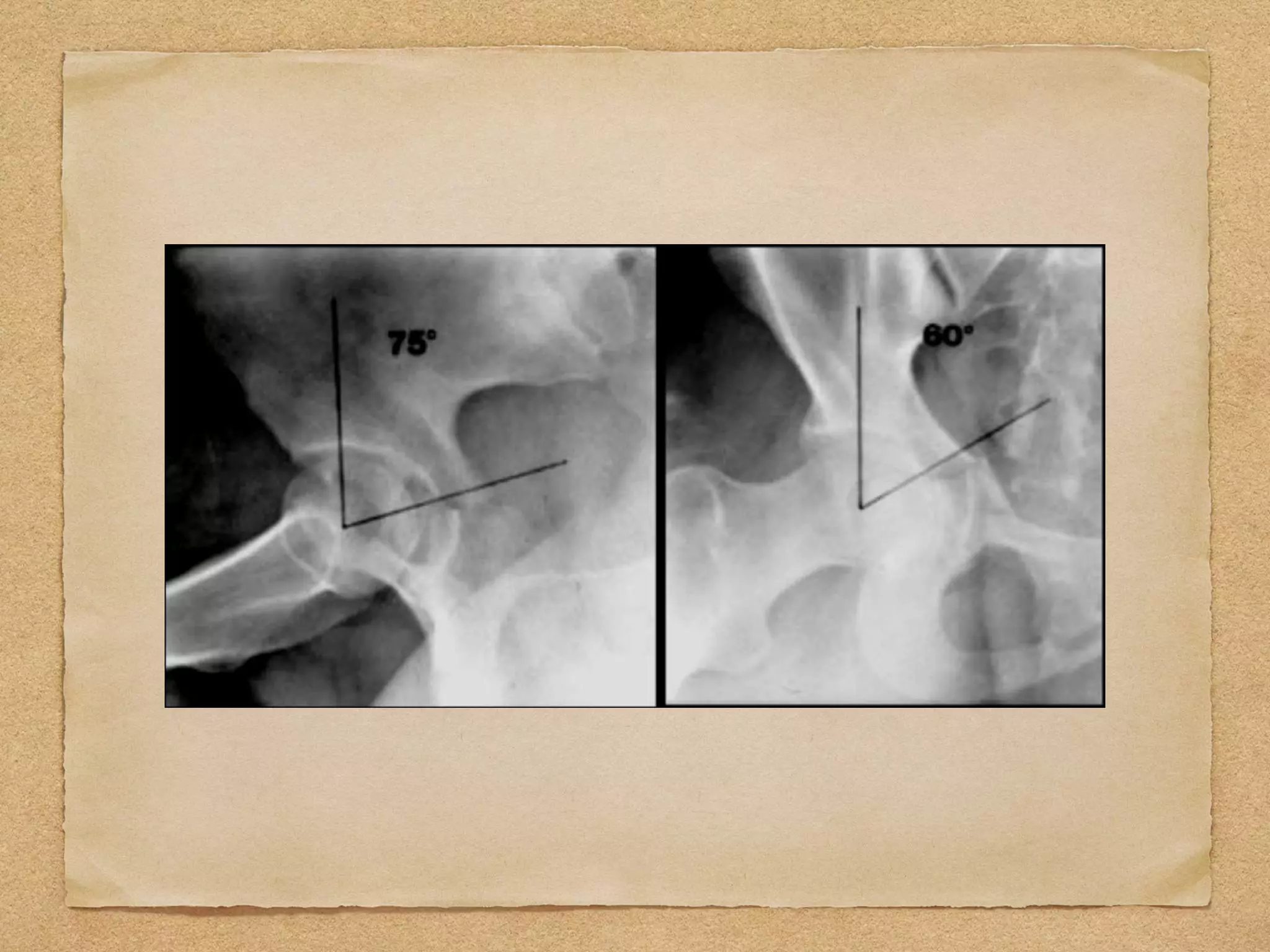 Acetabular Fracture Radiology: Xrays, CT scan & 3D printing | PPTX