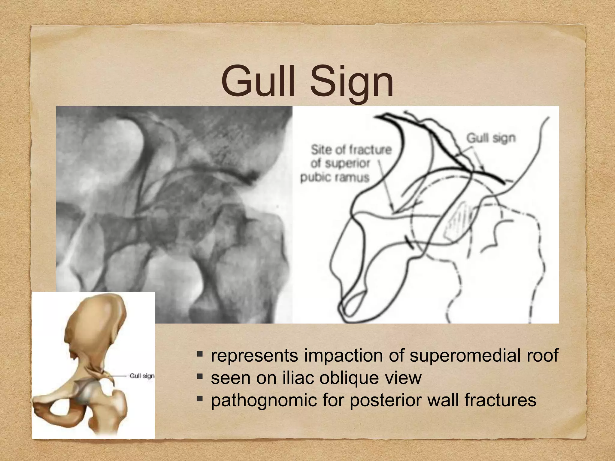 Acetabular Fracture Radiology Xrays Ct Scan And 3d Printing Ppt