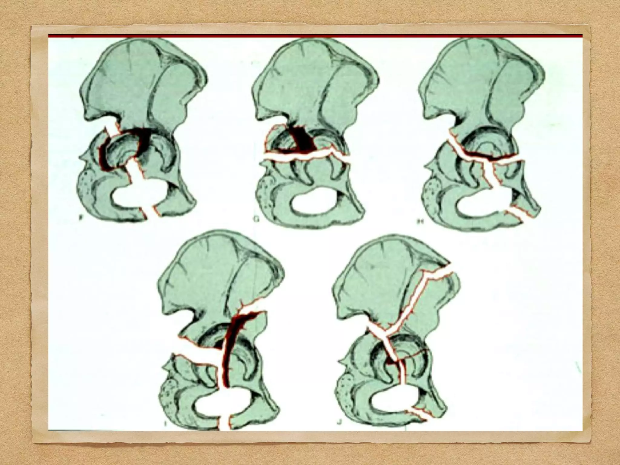 Acetabular Fracture Radiology: Xrays, CT scan & 3D printing | PPTX