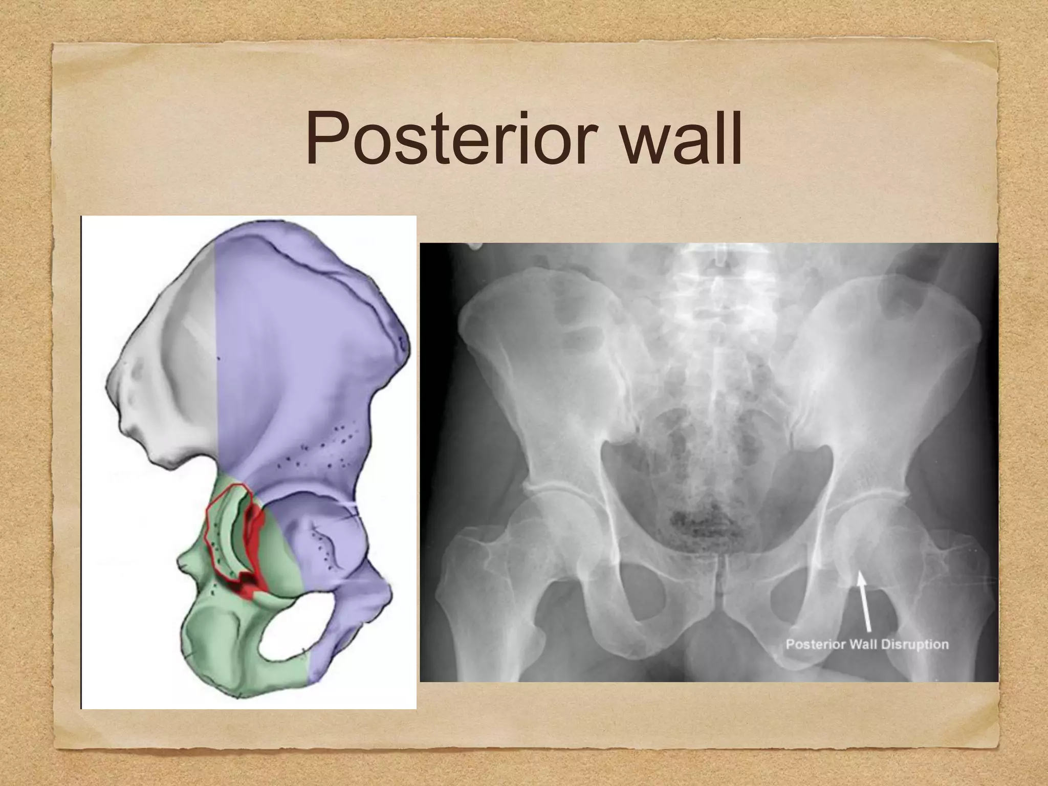 Acetabular Fracture Radiology: Xrays, CT scan & 3D printing | PPTX