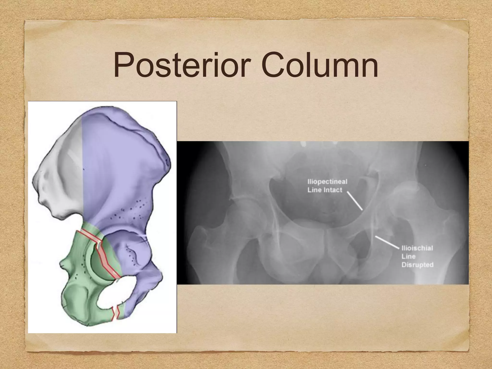 Acetabular Fracture Radiology: Xrays, CT scan & 3D printing | PPTX