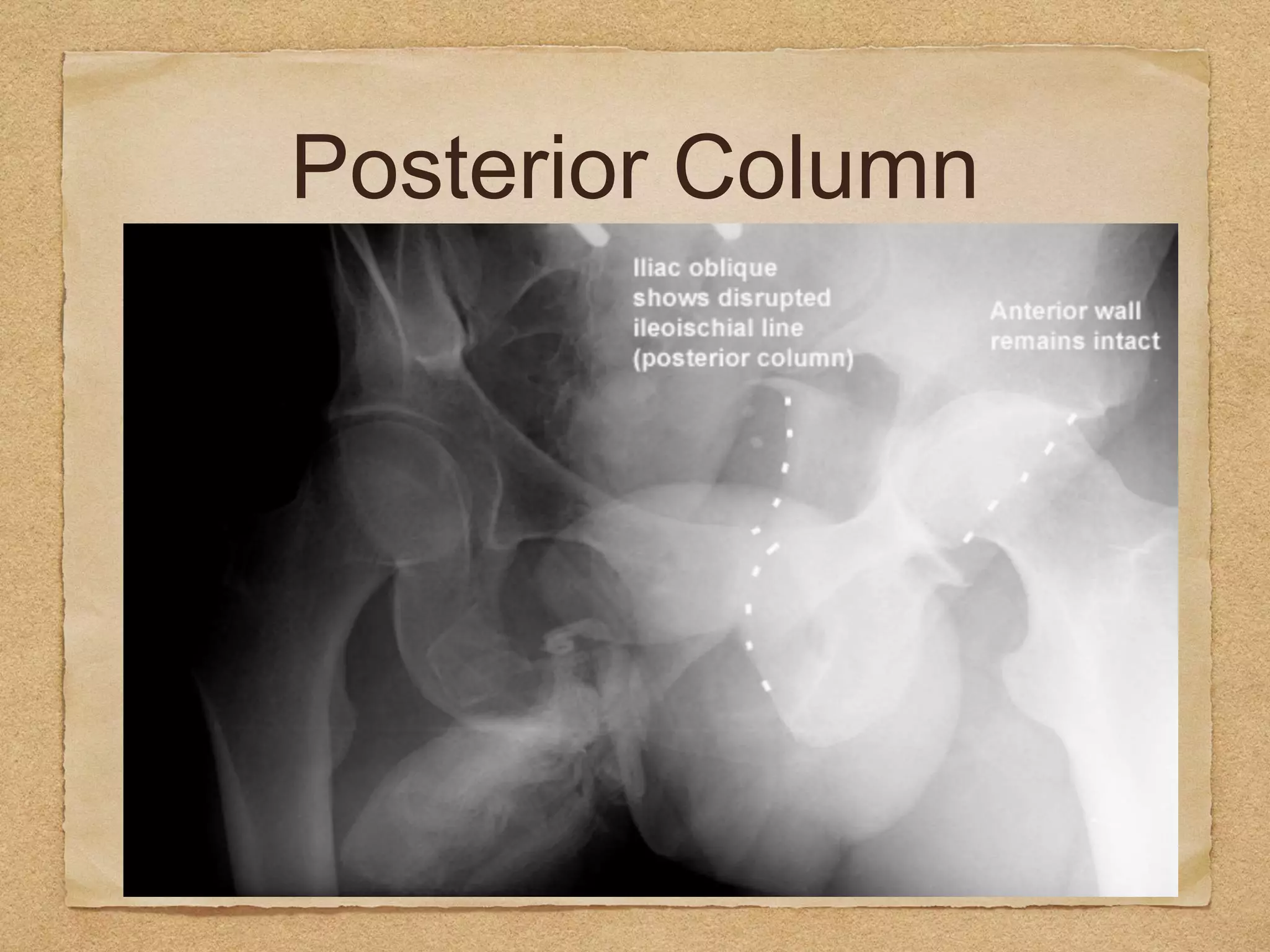 Acetabular Fracture Radiology: Xrays, CT scan & 3D printing | PPTX