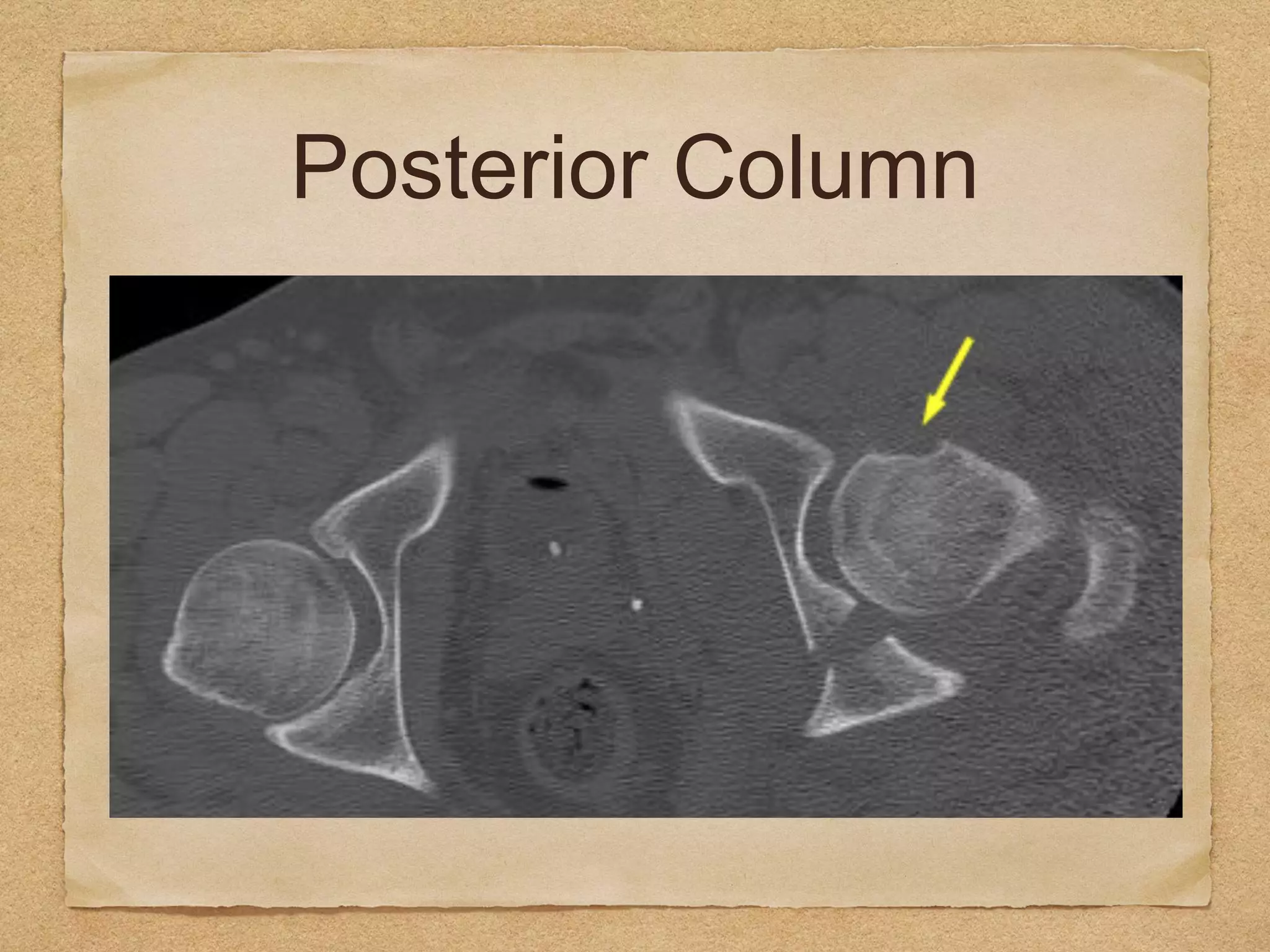 Acetabular Fracture Radiology: Xrays, CT scan & 3D printing | PPTX