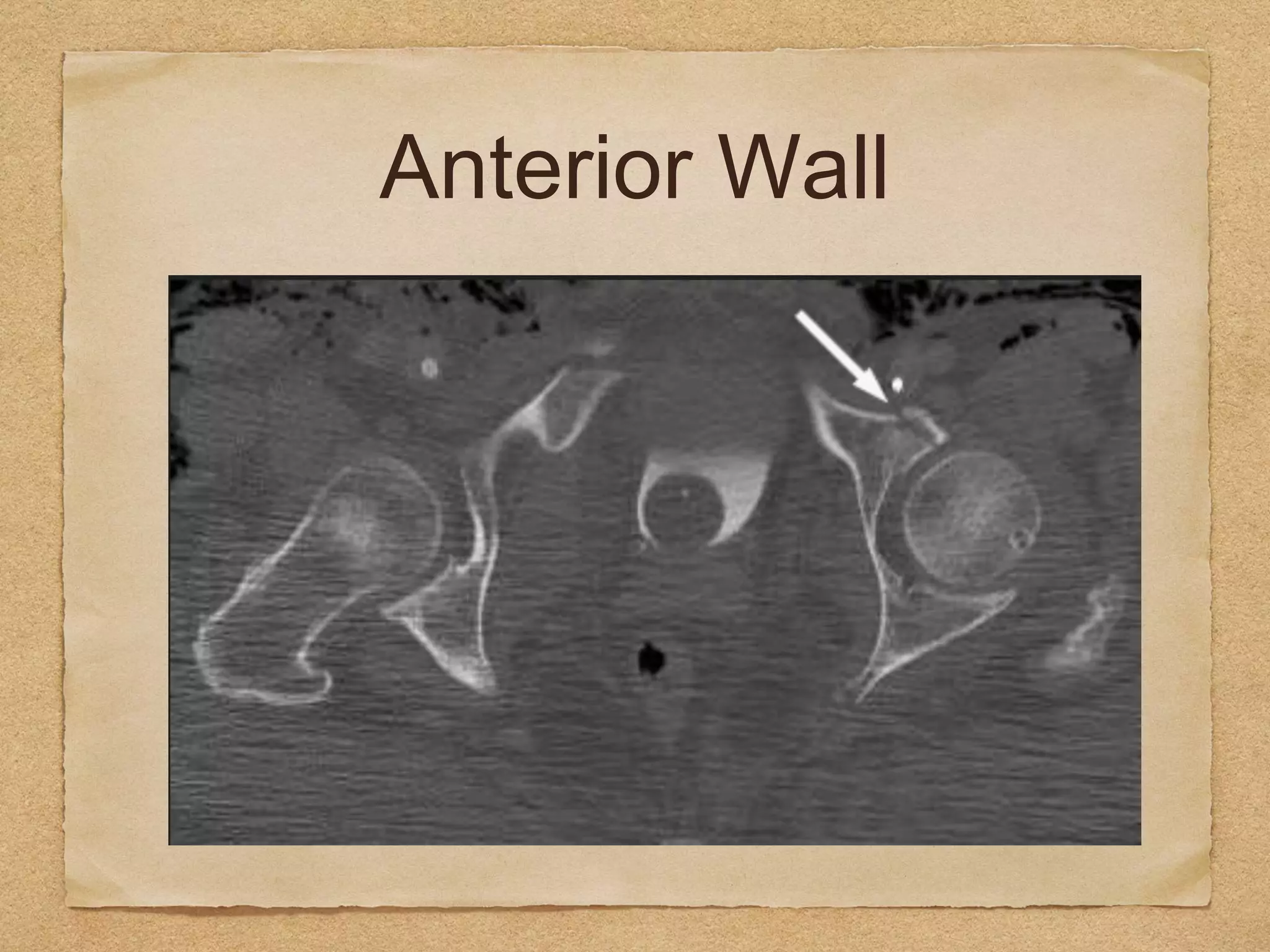 Acetabular Fracture Radiology: Xrays, CT scan & 3D printing | PPTX