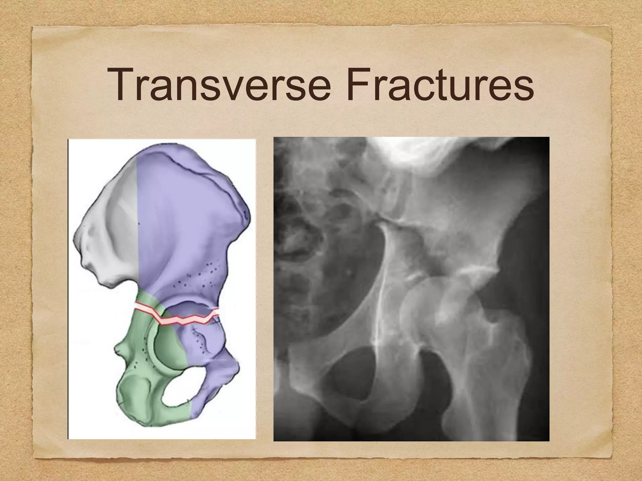 Acetabular Fracture Radiology: Xrays, CT scan & 3D printing | PPTX