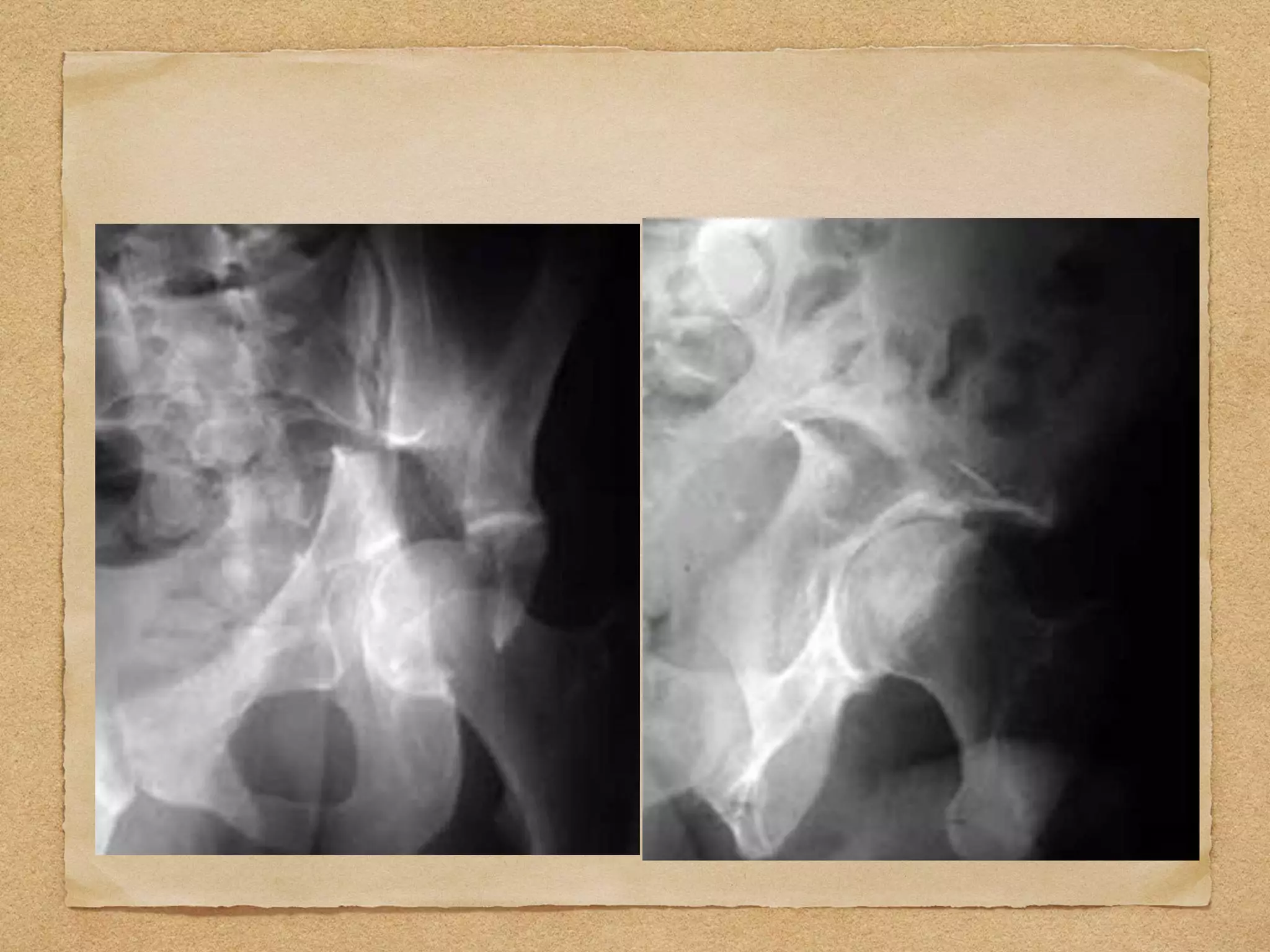 Acetabular Fracture Radiology Xrays Ct Scan And 3d Printing Pptx