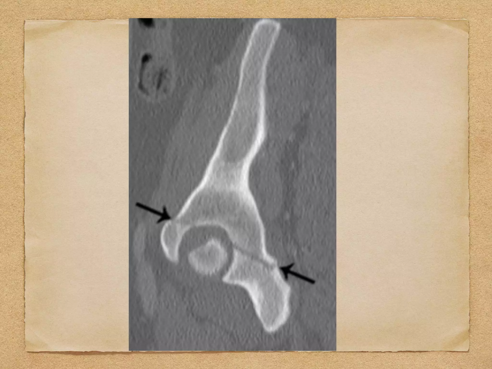 Acetabular Fracture Radiology: Xrays, CT scan & 3D printing | PPTX