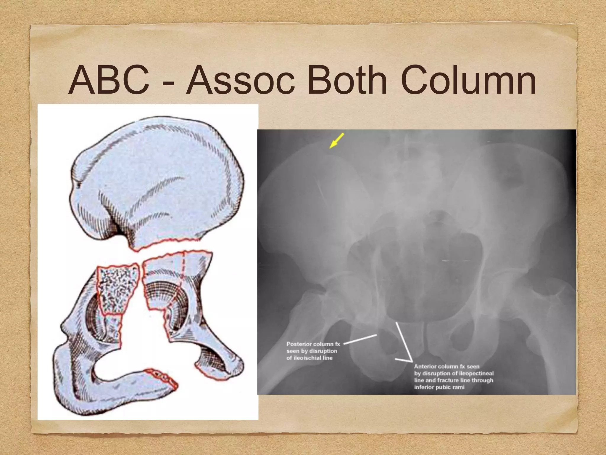 Acetabular Fracture Radiology: Xrays, CT scan & 3D printing | PPTX