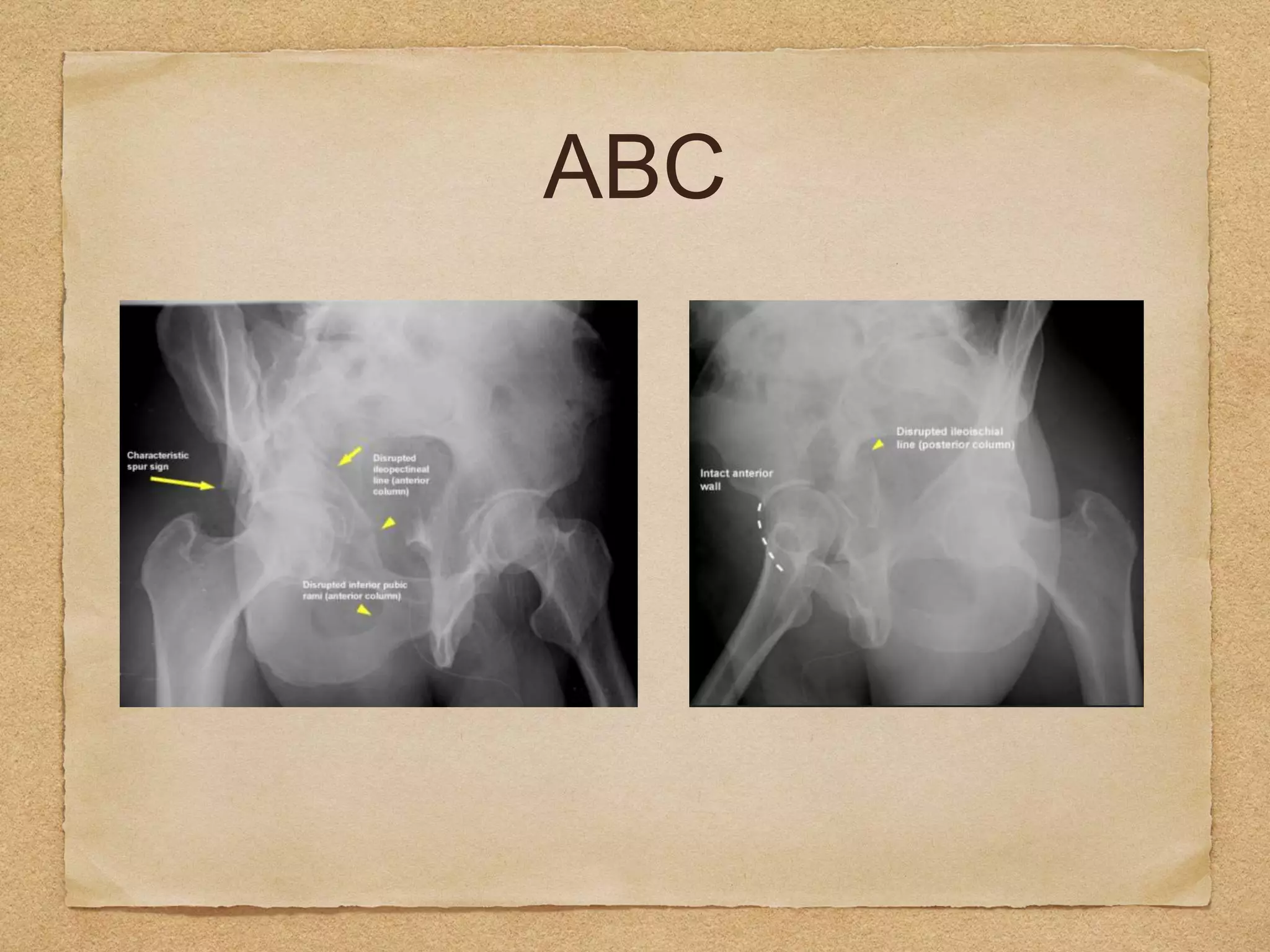 Acetabular Fracture Radiology Xrays Ct Scan And 3d Printing Pptx